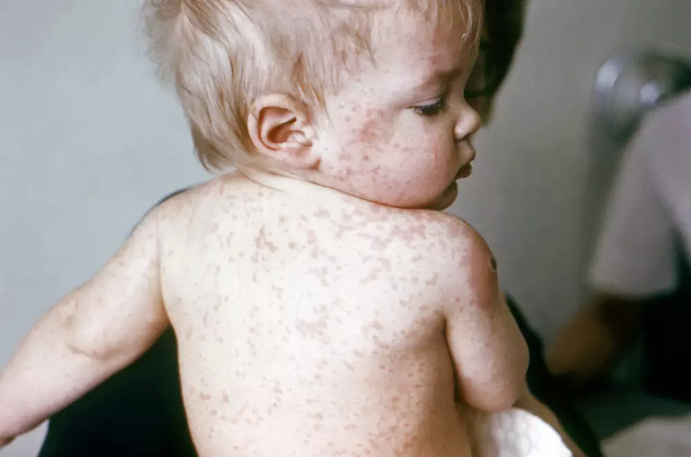 Measles na-eme ka usoro mgbochi ahụ ghara ịdị ike ruo ọtụtụ afọ