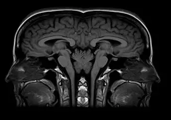 Neuroimagingová zaujatost vůči levákům